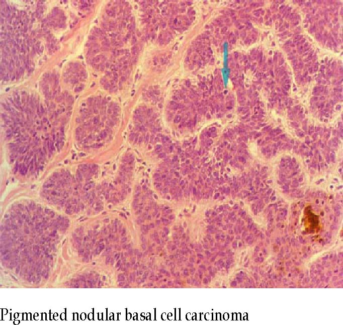 Basal cell carcinoma with peripheral palisading