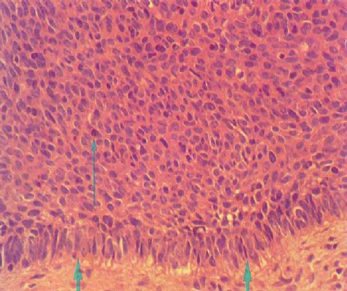 Basal cell carcinoma with peripheral palisading