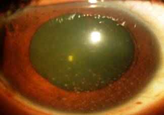 Mutton Fat Keratic Precipitates