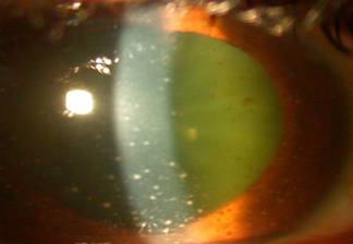 Mutton Fat Keratic Precipitates