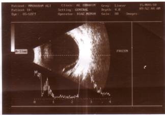 Fig. 5. Serous retinaldetachment in right eye on Ultrasonic B-scan