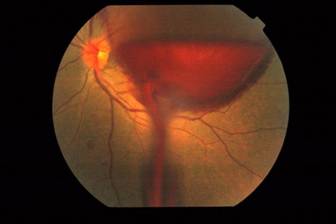 Fig.1: Subhyaloid hemorrhage