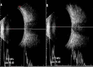Figure 2: Day 9 B-Scan Ultrasonography. A: Right eye showing slight ...