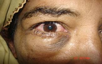 Fig.2: Subciliary incision sutured with 7/0Vicryl with mild lower lid ...