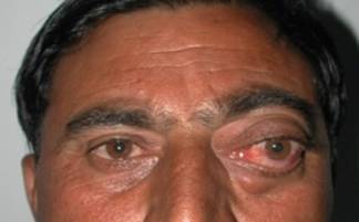 Fig. 3: Proptosis and suprotemporal dystopia of left eye.