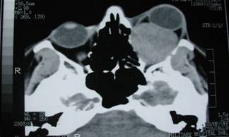 Fig. 4: CT scan axial view showing large well circumscribed ...