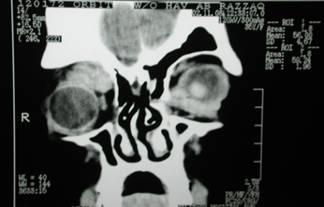 Fig. 7: CT – Scan revealed a large extraconal, wellcircumscribed lesion ...