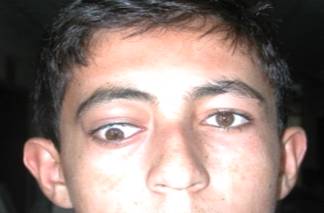 Fig. 10: Inferior dystopia and proptosis of right eye.