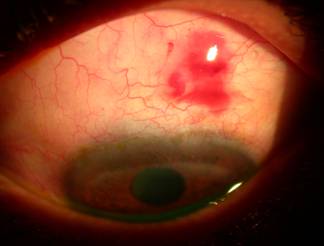 Fig. 5: Formation of bleb