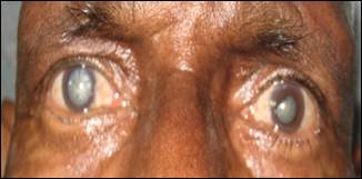 Fig. 1: Bilateral electric cataract with posterior synechiae in the ...