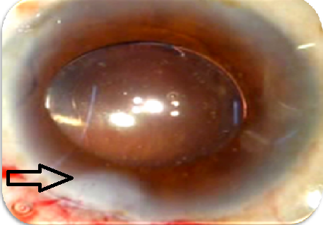 Fig.1: After2 months of phaco surgery showing corneal burn at the site ...