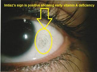 Fig. 1: Imtiaz’s Sign.