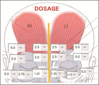 Fig 1: Periocularsites for botulinum toxin injection.
