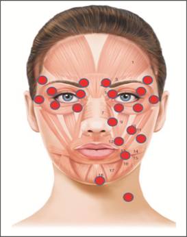5) Severe, incapacitating eyelids and facial muscles spasm.